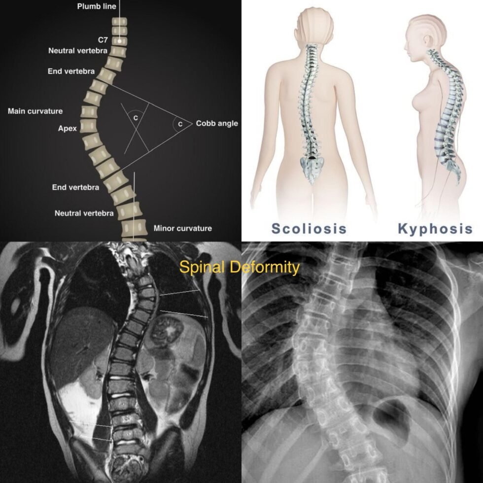 Spinal Deformity - Dr. Bharat Shinde
